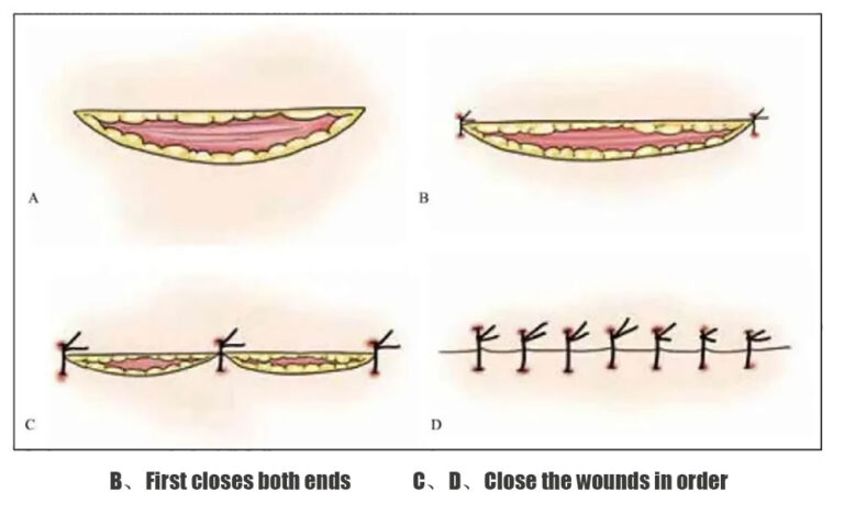 A Comprehensive Guide to Surgical Suturing Techniques