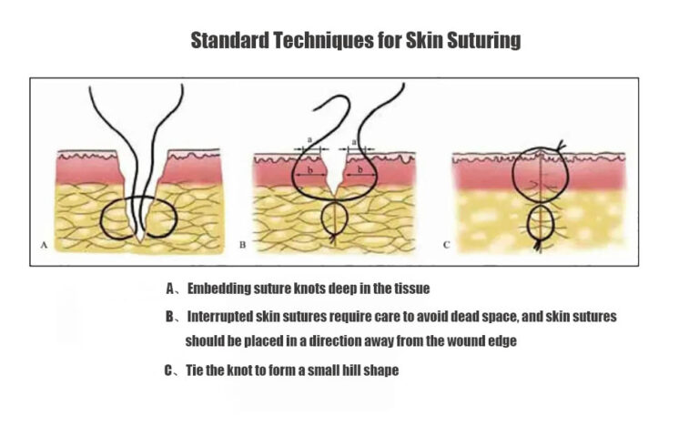 A Comprehensive Guide to Surgical Suturing Techniques